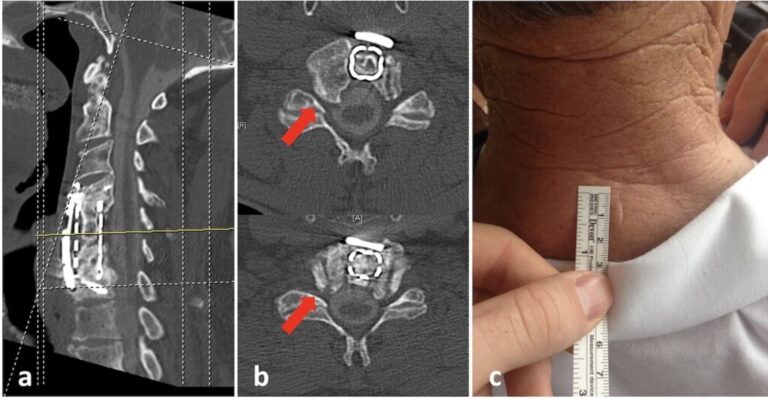 Knöcherne Nervenkanalverengung (Neuroforamenstenose ...