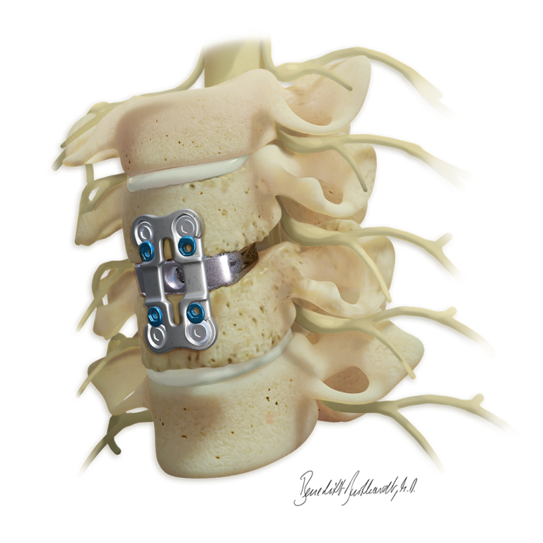 Verengter Halswirbelkanal (Zervikale Spinalkanalstenose ...